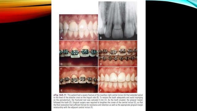 Orthodontist periodontist Ortho-perio lecture .pptx