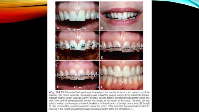 Orthodontist periodontist Ortho-perio lecture .pptx