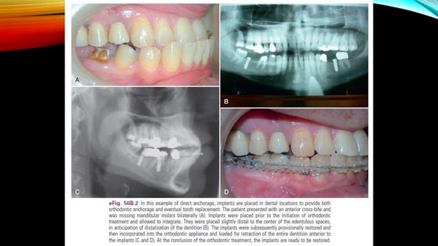 Orthodontist periodontist Ortho-perio lecture .pptx