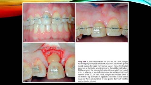 Orthodontist periodontist Ortho-perio lecture .pptx