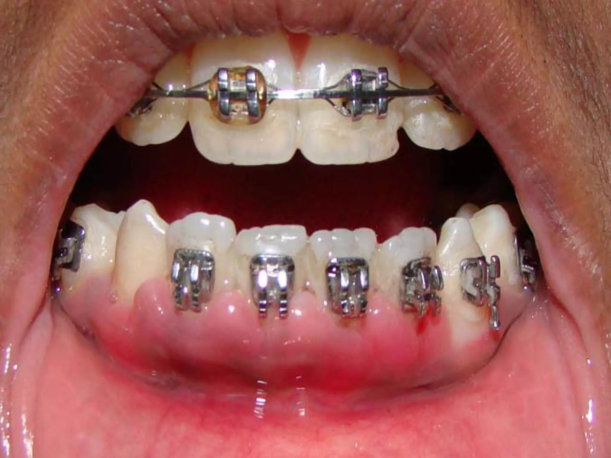 Ortho-Perio Relationship | PDF | Dental Health | Diseases and Conditions