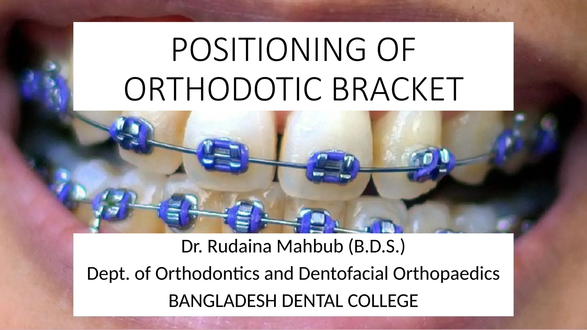 PLACEMENT OF ORTHODOTIC BRACKET. pptx | PPTX