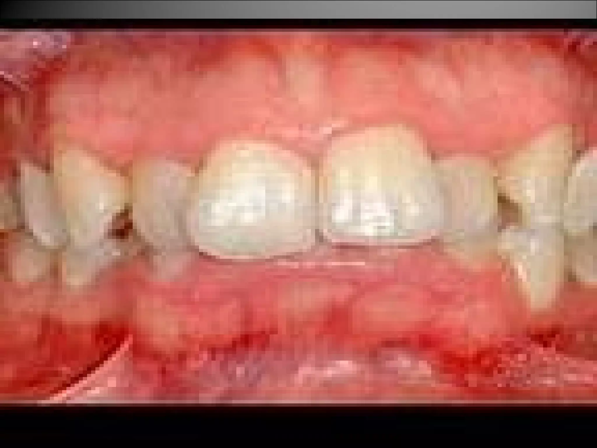 Class1 Malocclusion Ppt Ppt