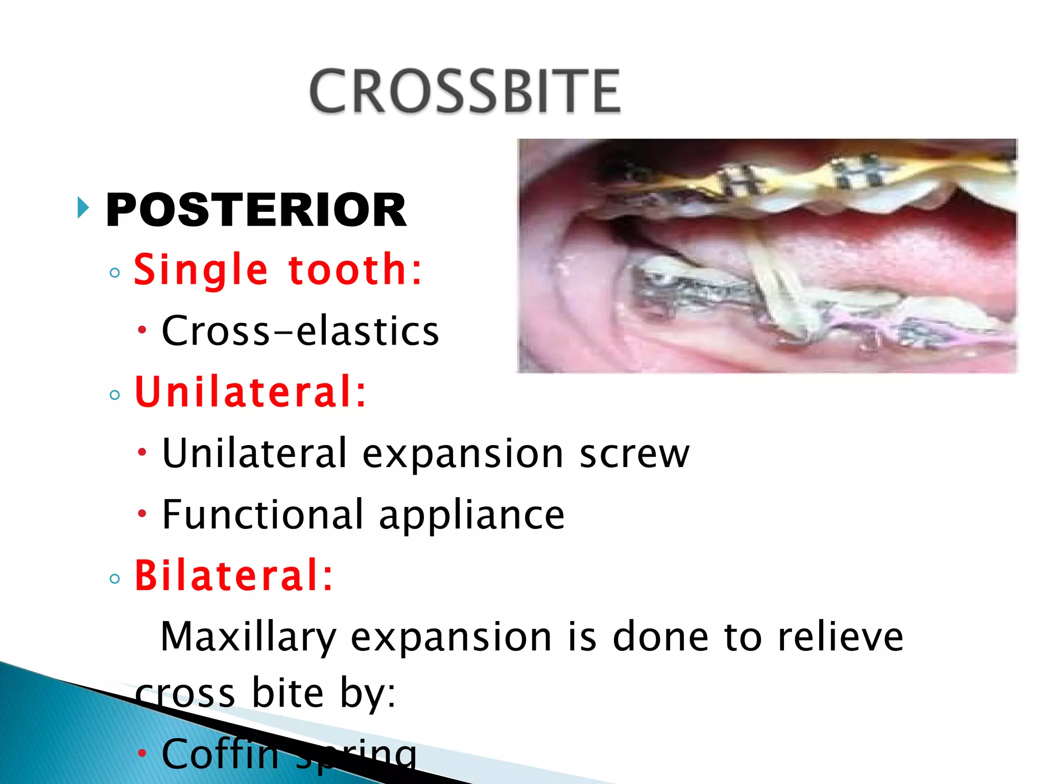Class1 Malocclusion Ppt Ppt
