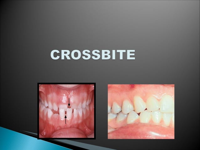 Class1 Malocclusion Ppt Ppt