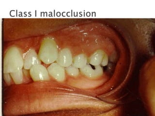 class1 malocclusion ppt | PPT