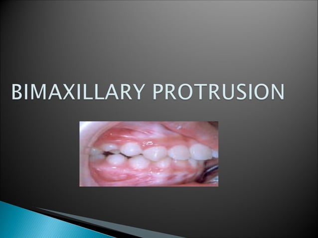 Class1 Malocclusion Ppt Ppt