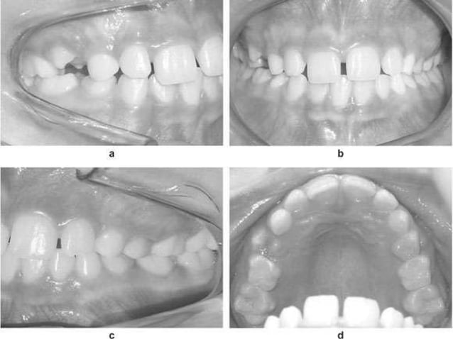 Class1 Malocclusion Ppt Ppt