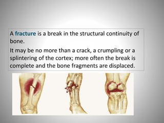 management of closed fracture | PPTX
