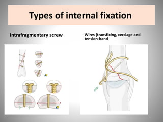 management of closed fracture | PPTX