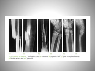 management of closed fracture | PPTX