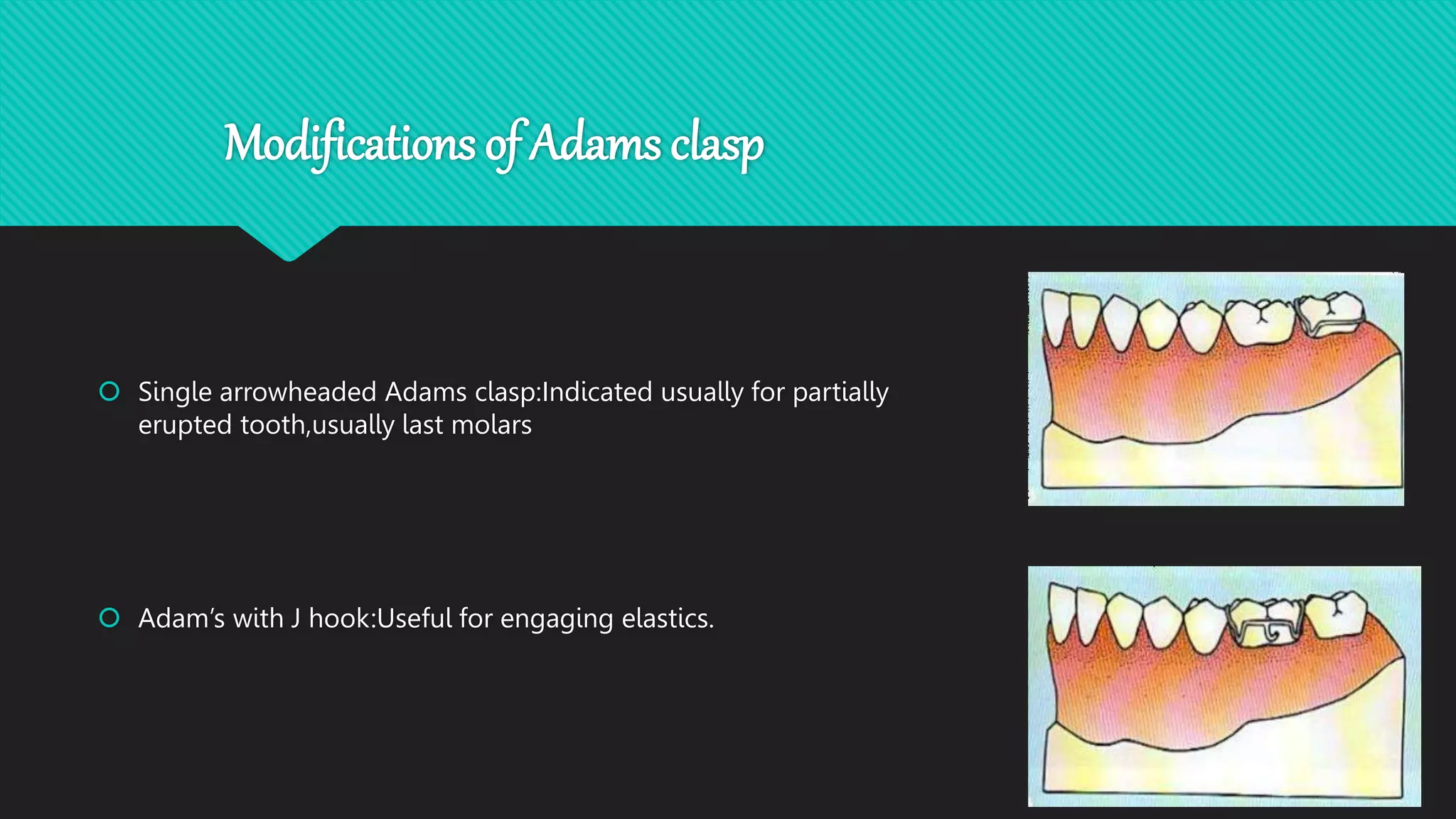 Adams clasp theory and fabrication | PPTX