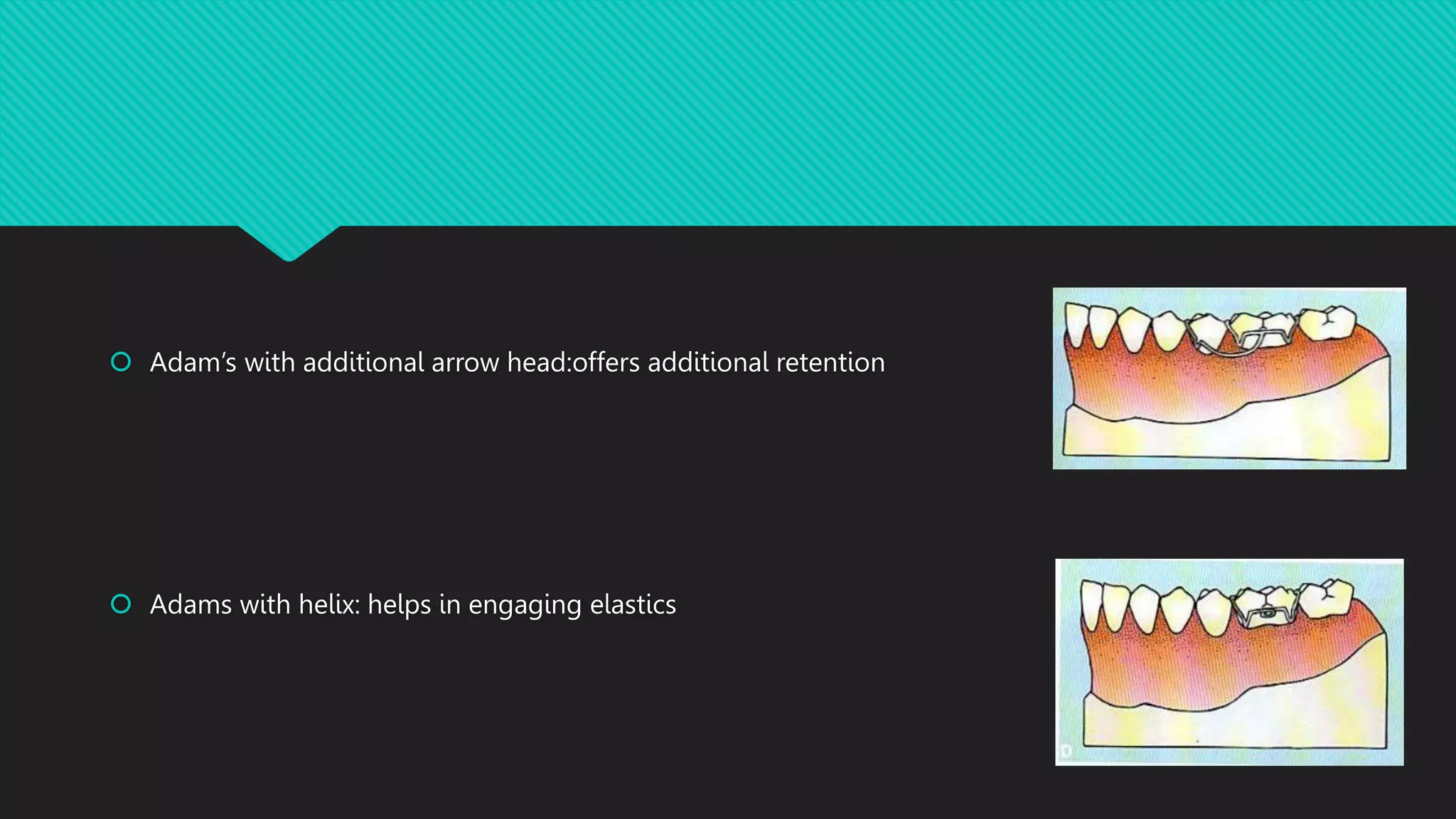 Adams clasp theory and fabrication | PPTX
