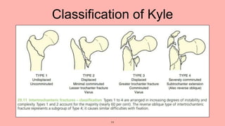 Intertrochanteric fracture | PPTX