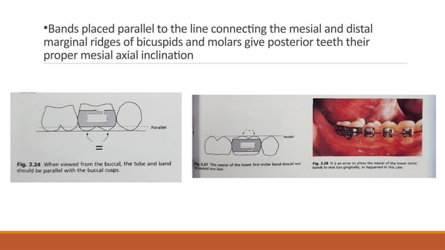 ORTHO BANDS.pptx vgghj hgjbk bk bjk j nk,n,jk | PPT