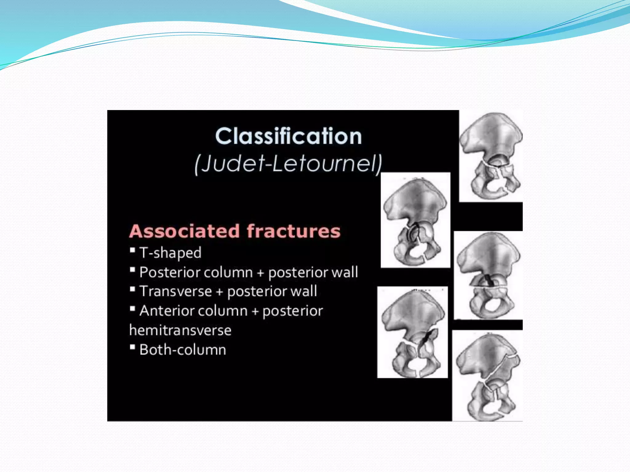 acetabulum fracture orthocon 2018 | PPT | Free Download