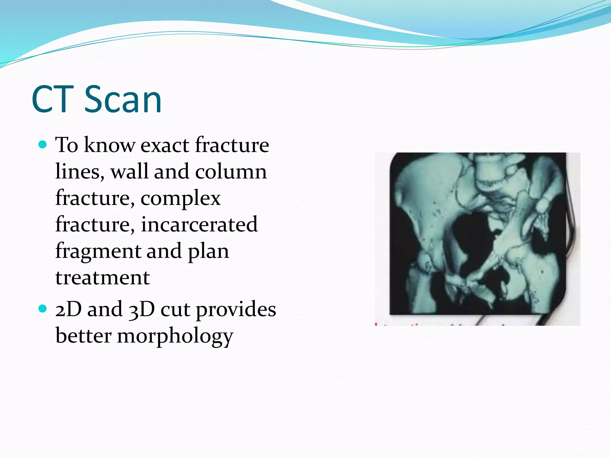 acetabulum fracture orthocon 2018 | PPT