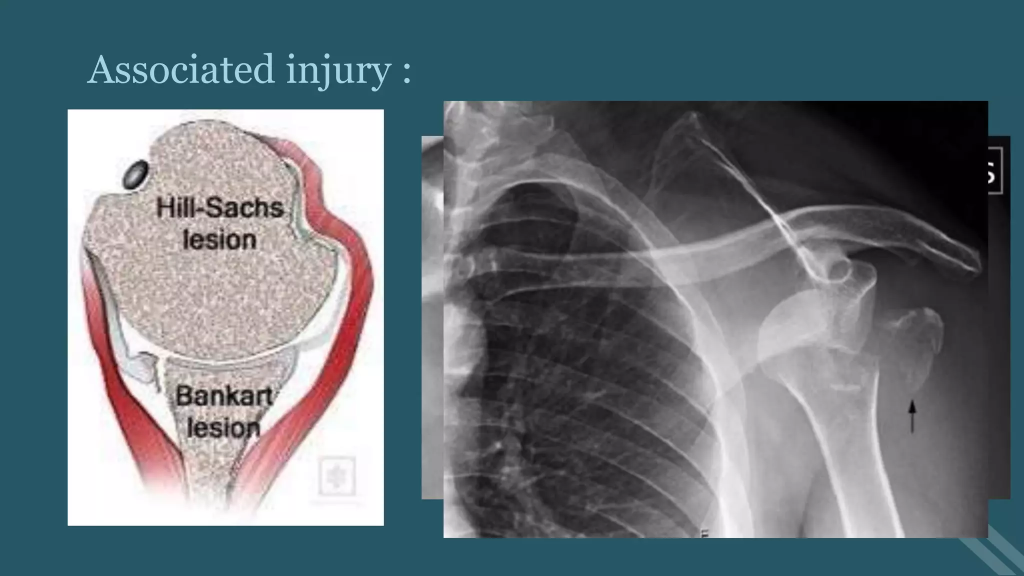 Ortho conference - anterior shoulder dislocation | PPT
