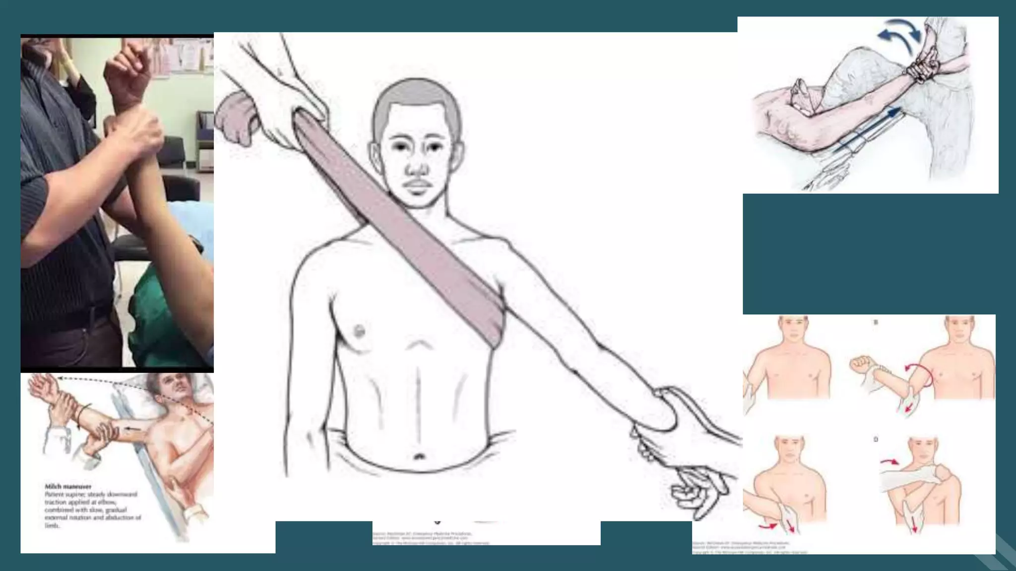 Ortho conference - anterior shoulder dislocation | PPT