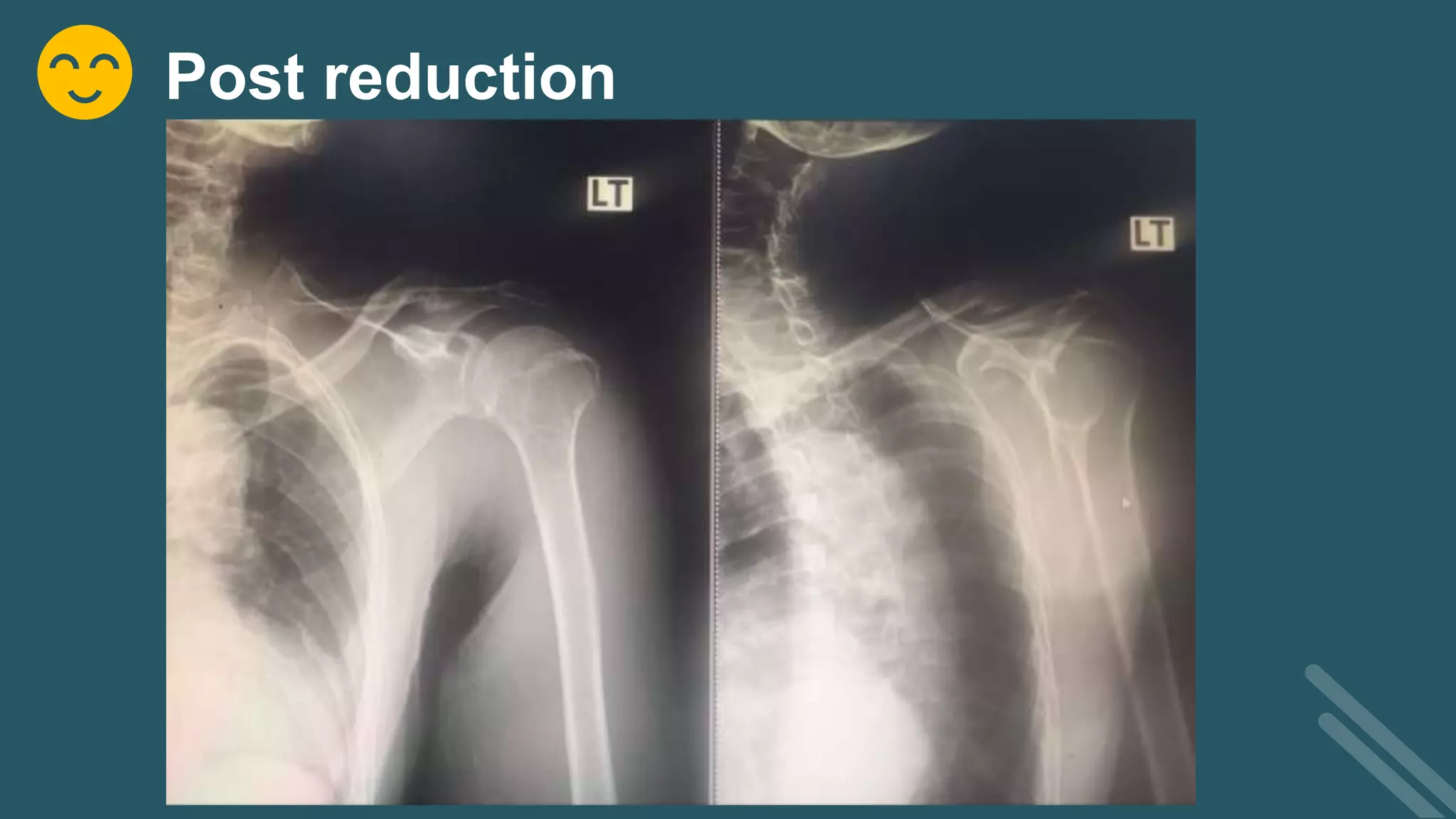 Ortho conference - anterior shoulder dislocation | PPT