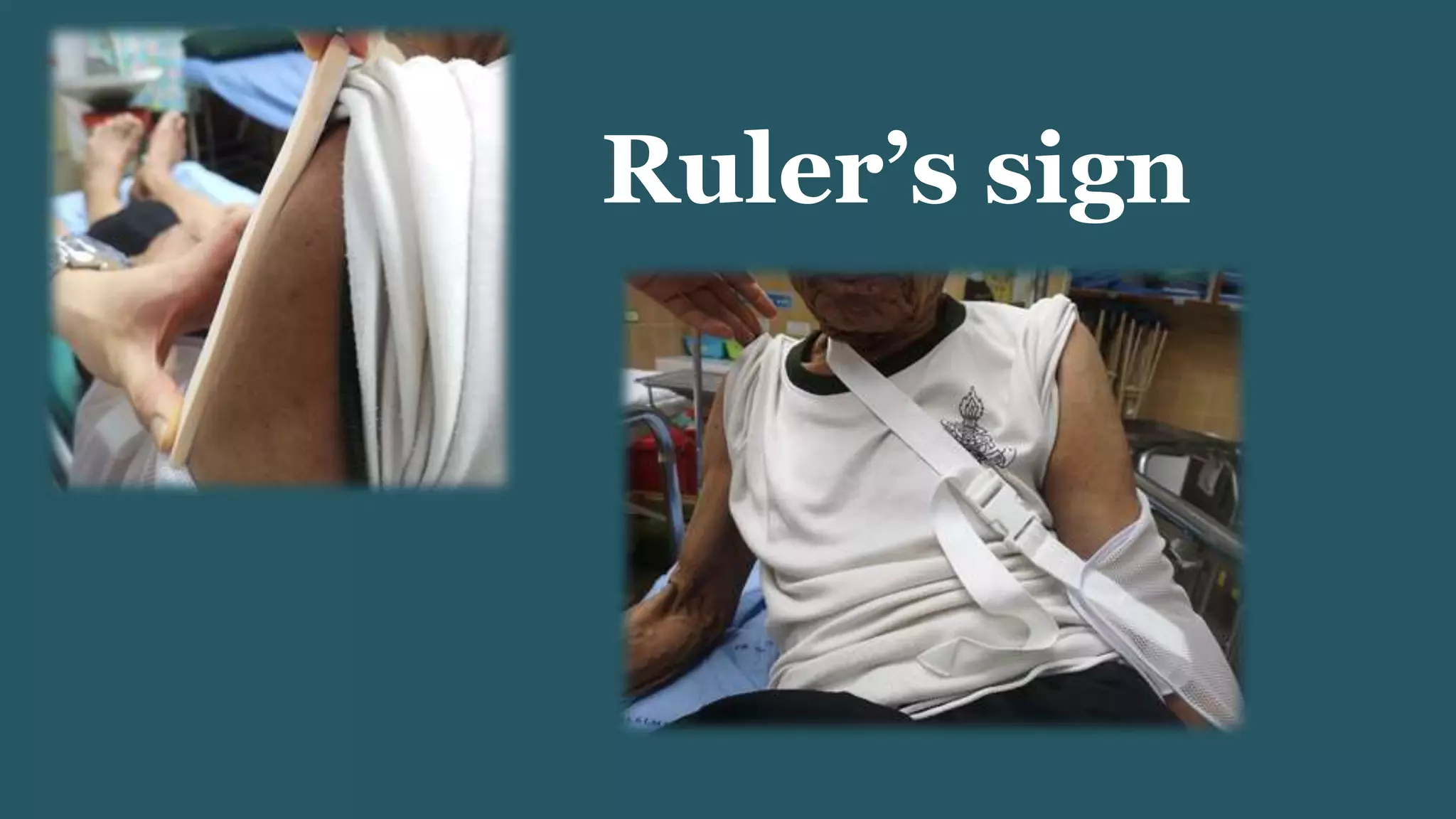 Ortho conference - anterior shoulder dislocation | PPT