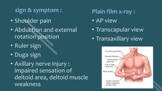 Ortho conference - anterior shoulder dislocation | PPT