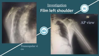 Ortho conference - anterior shoulder dislocation | PPT