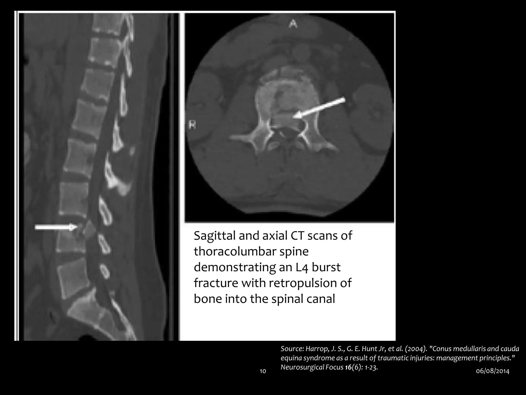 Conus medullaris and cauda equina syndrome | PPTX