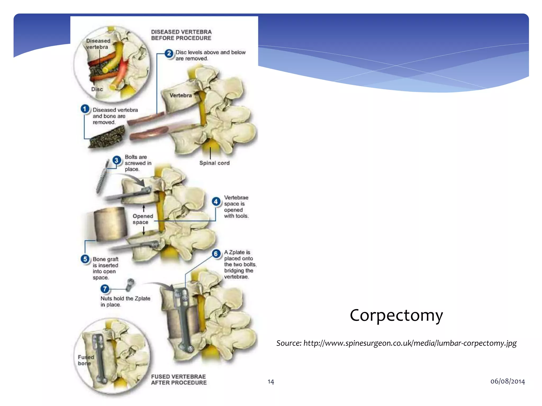 Conus medullaris and cauda equina syndrome | PPTX