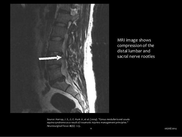 Conus medullaris and cauda equina syndrome