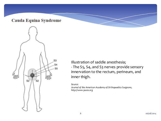 Conus medullaris and cauda equina syndrome