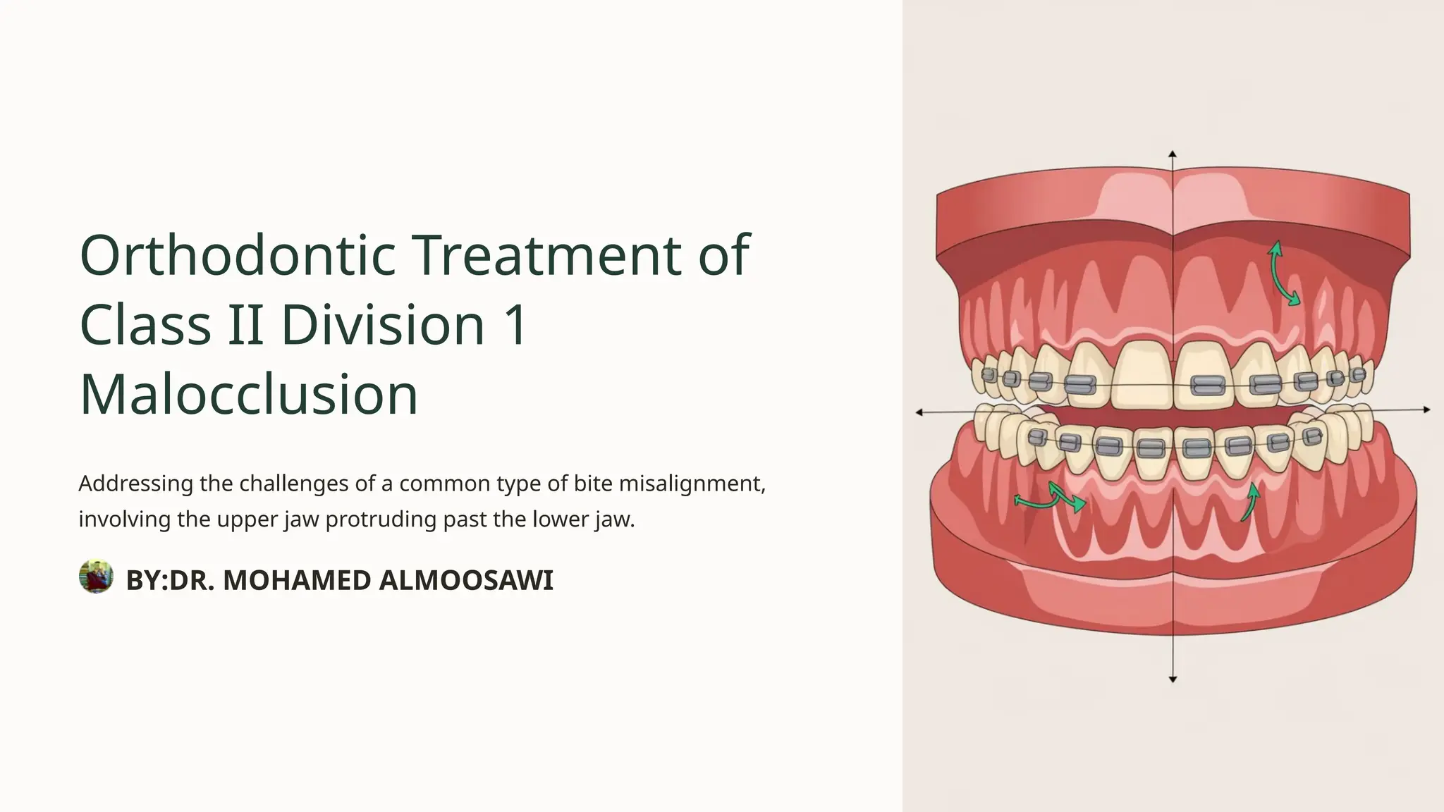 Orthodontic-Treatment-of-Class-II-Division-1-Malocclusion.pptx