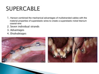 Orthodontic-wires ppt | PPT