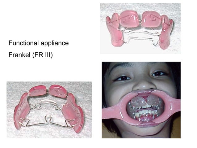 Orthodontic Appliance | PPT