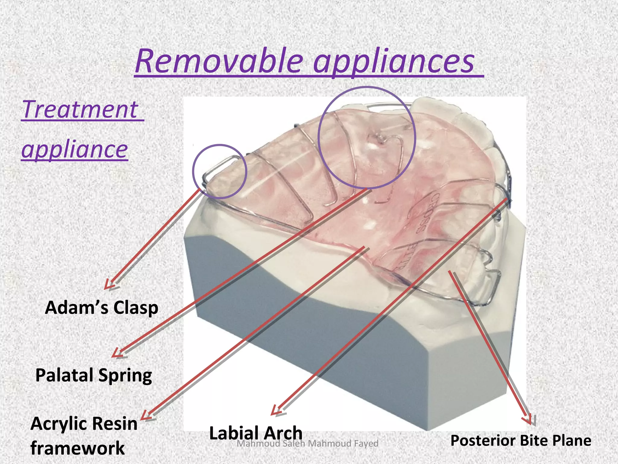 Orthodontic appliances | PPT