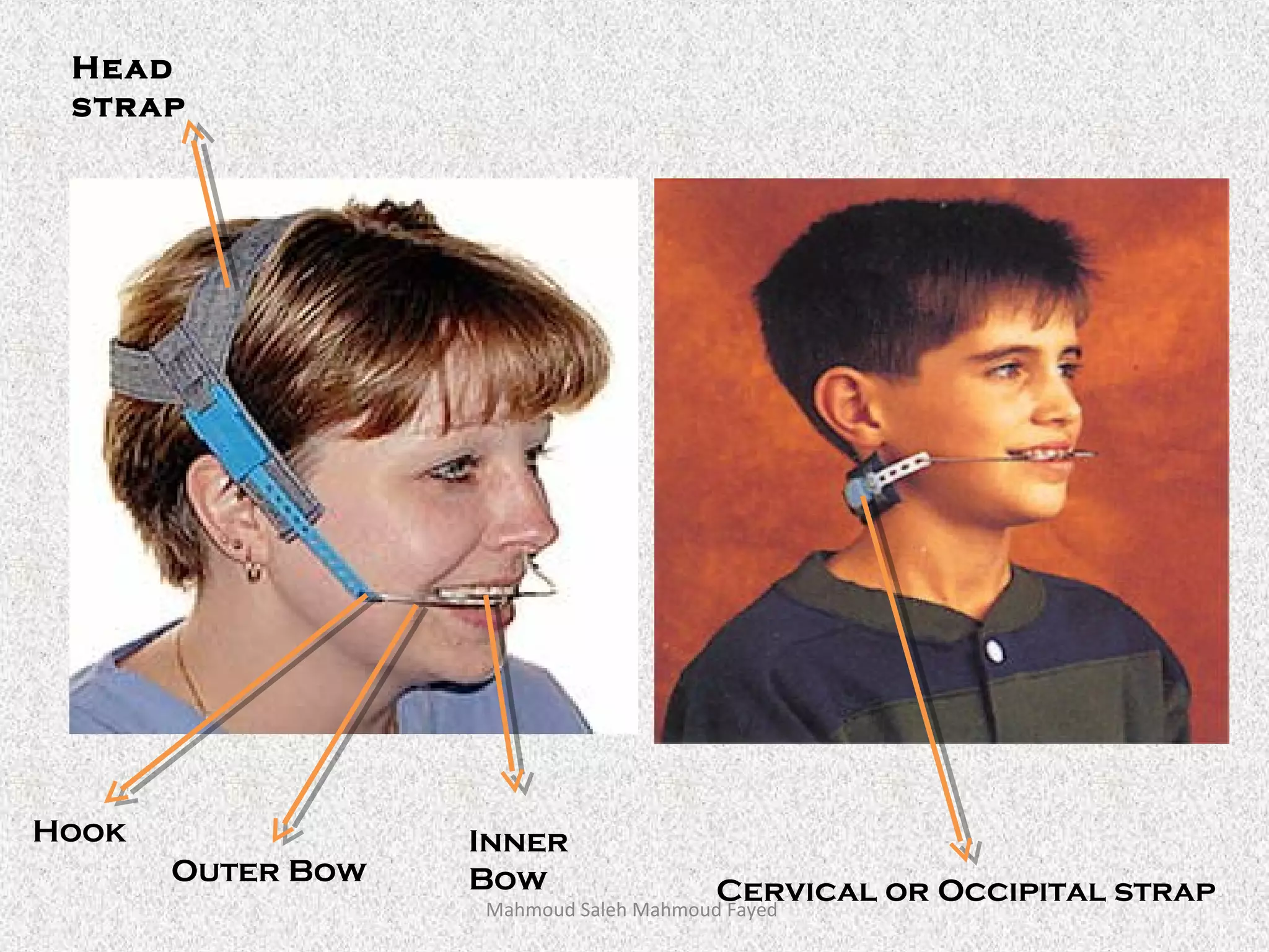 Orthodontic appliances | PPT