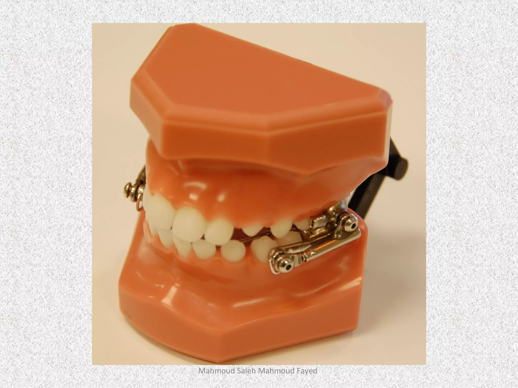 Orthodontic appliances | PPT