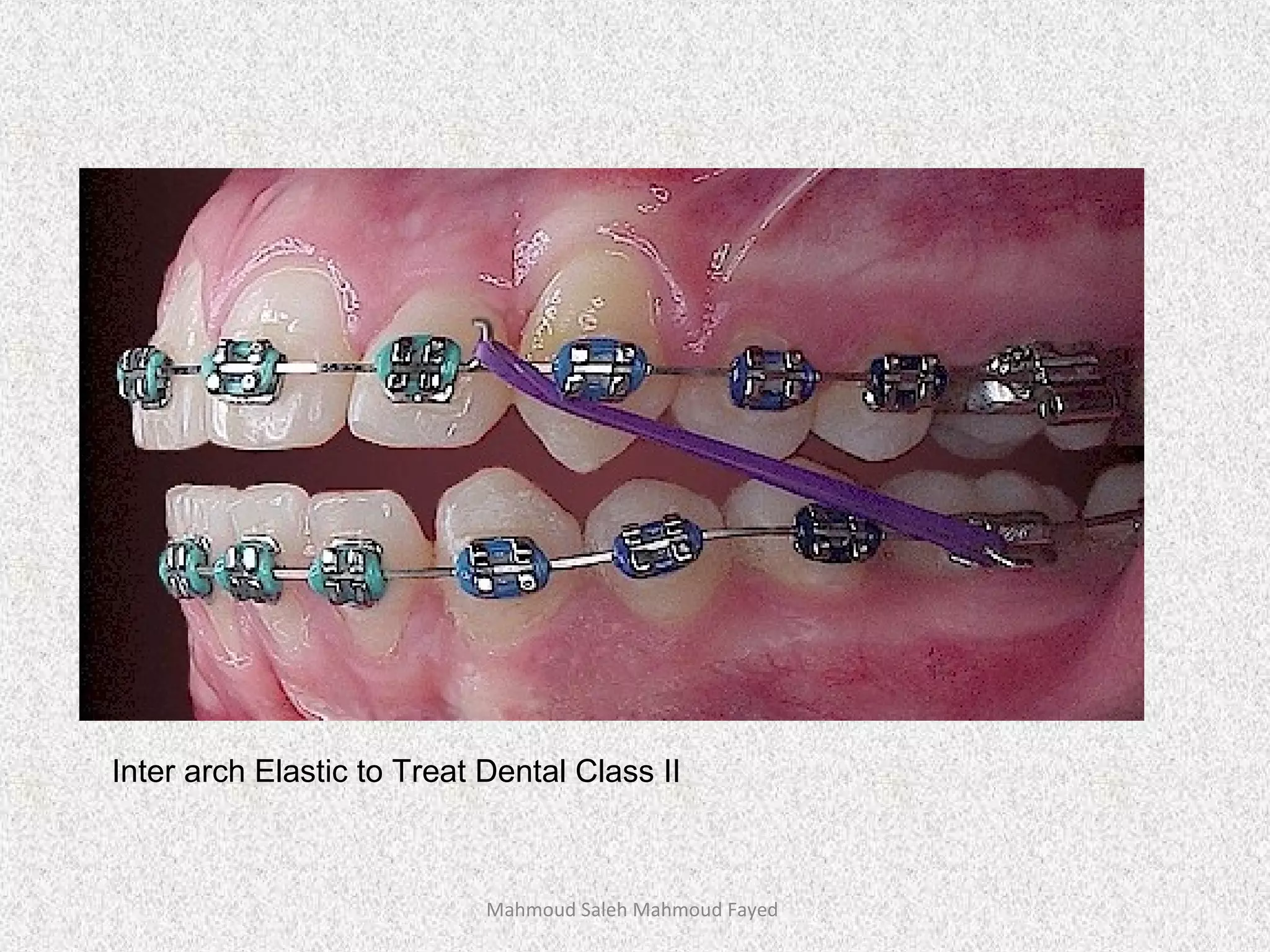 Orthodontic appliances | PPT