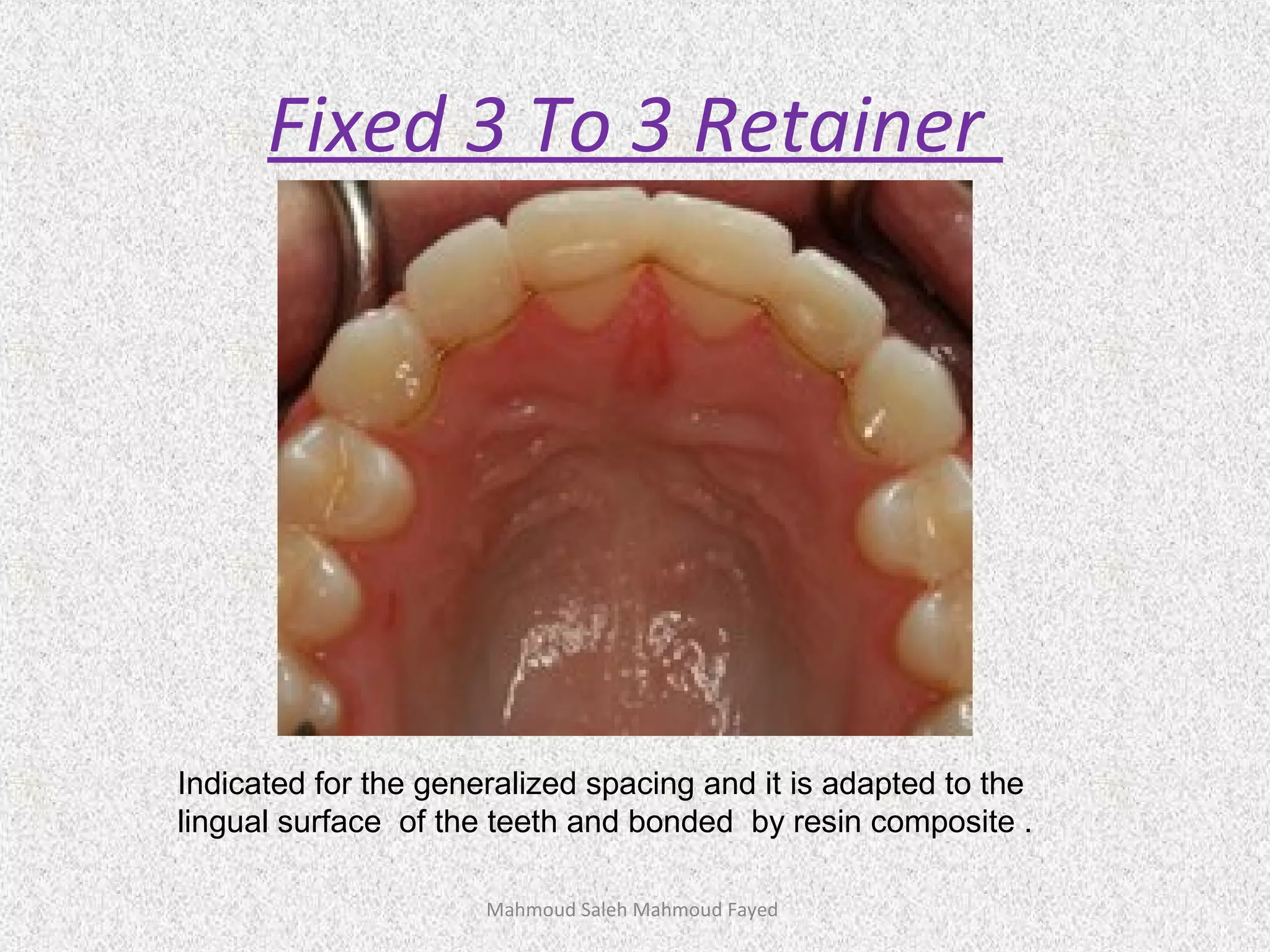 Orthodontic appliances | PPT