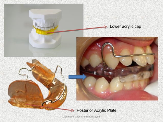 Orthodontic appliances | PPT | Dental Health | Diseases and Conditions
