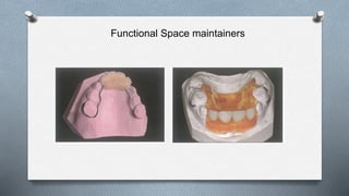 Orthodontic Appliances | PPTX