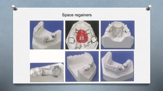 Orthodontic Appliances | PPTX
