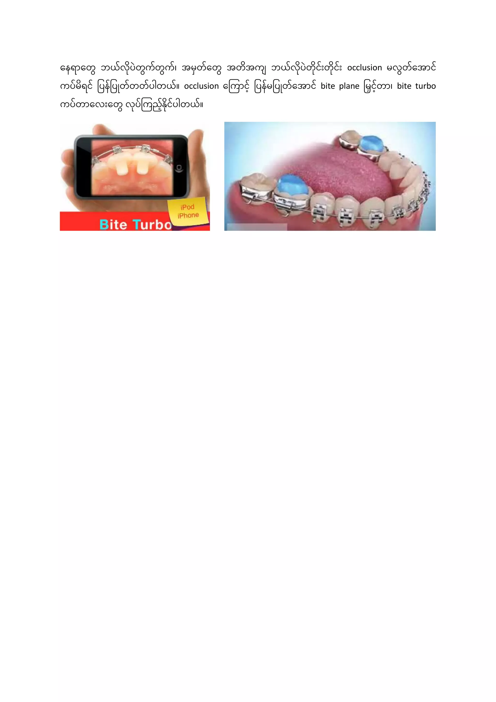 Orthodontic bracket positioning by dr nayaung | PDF