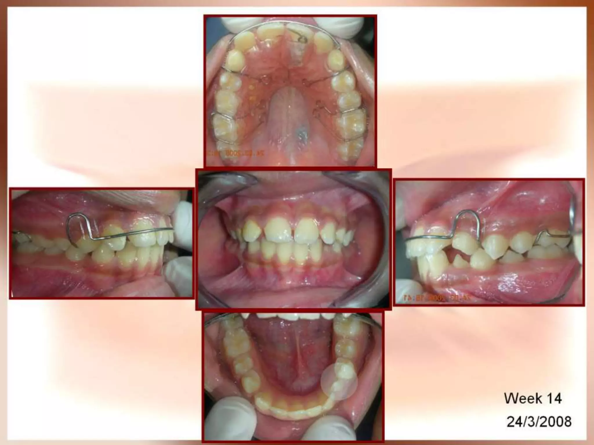 Orthodontic case presentation | PPTX