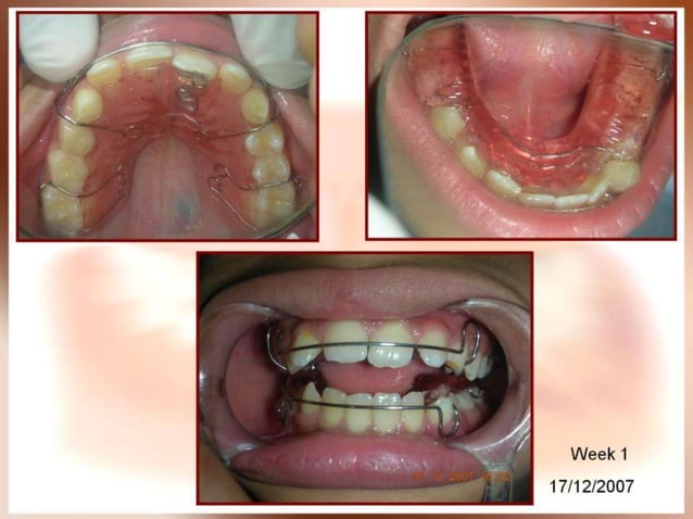 Orthodontic case presentation | PPTX | Dental Health | Diseases and ...