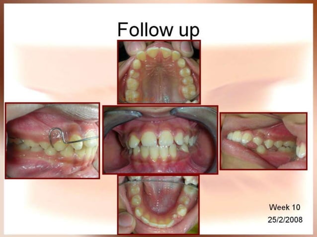 Orthodontic case presentation | PPTX | Dental Health | Diseases and ...