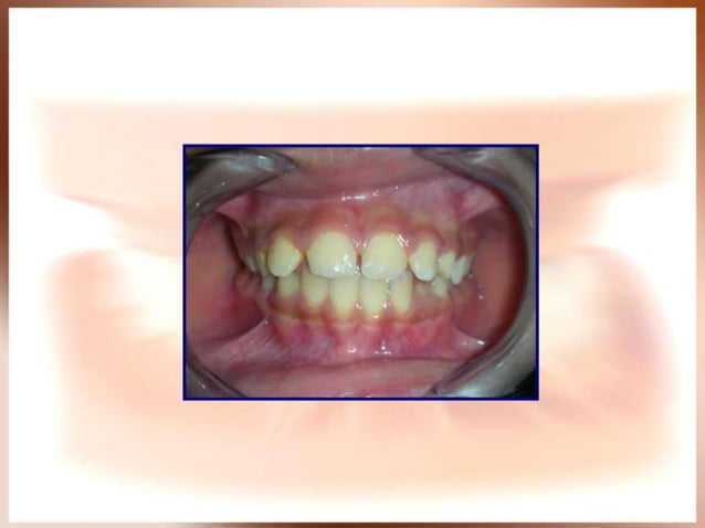Orthodontic case presentation | PPTX | Dental Health | Diseases and ...