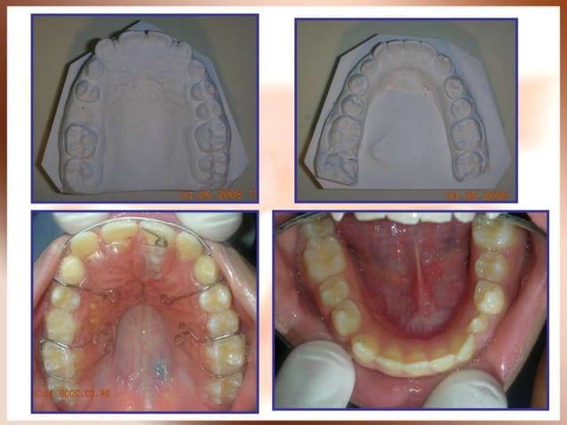Orthodontic case presentation | PPTX | Dental Health | Diseases and ...