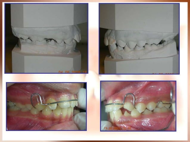Orthodontic case presentation | PPTX | Dental Health | Diseases and ...