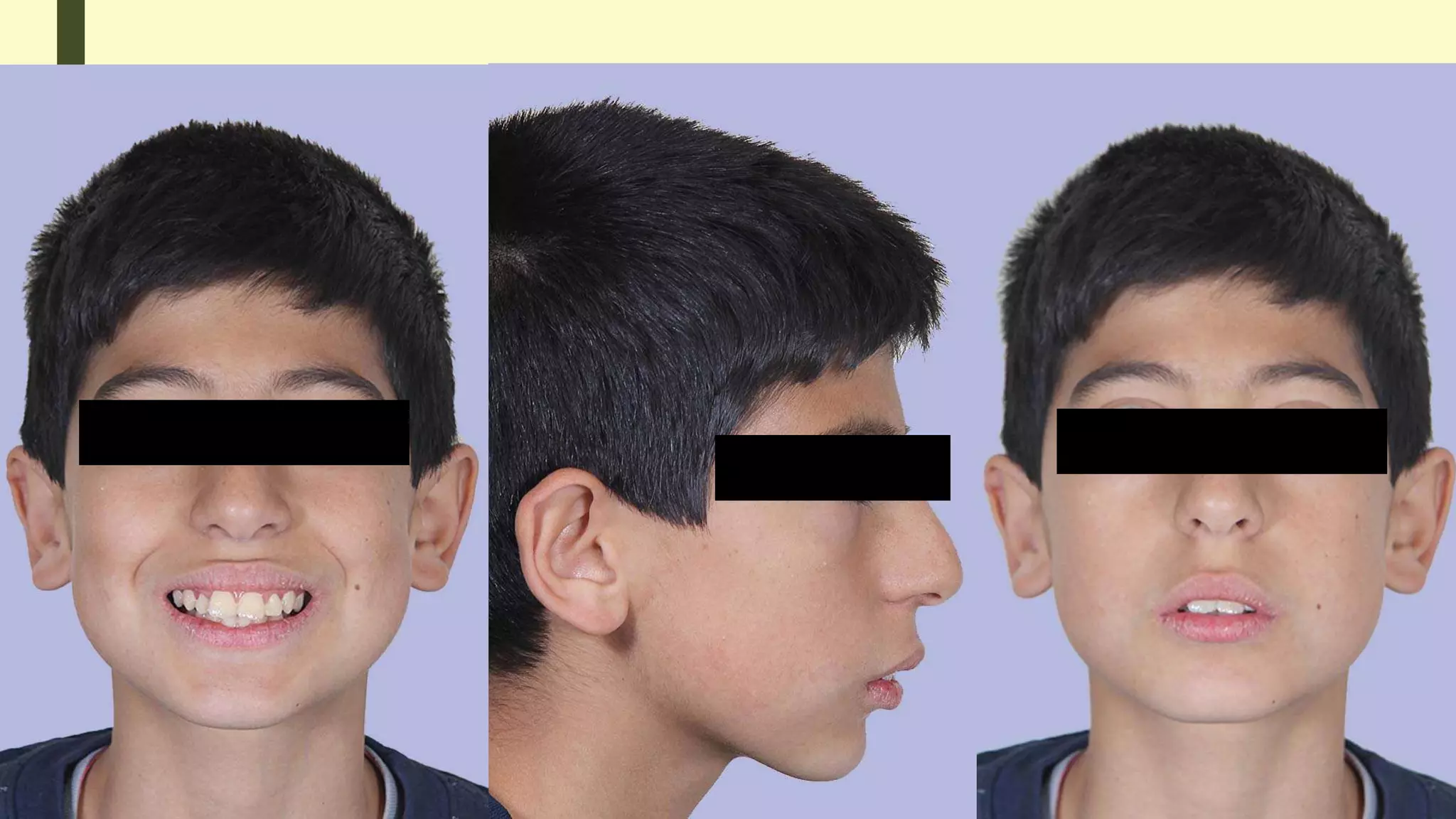an Example for Orthodontic case presentation | PPTX